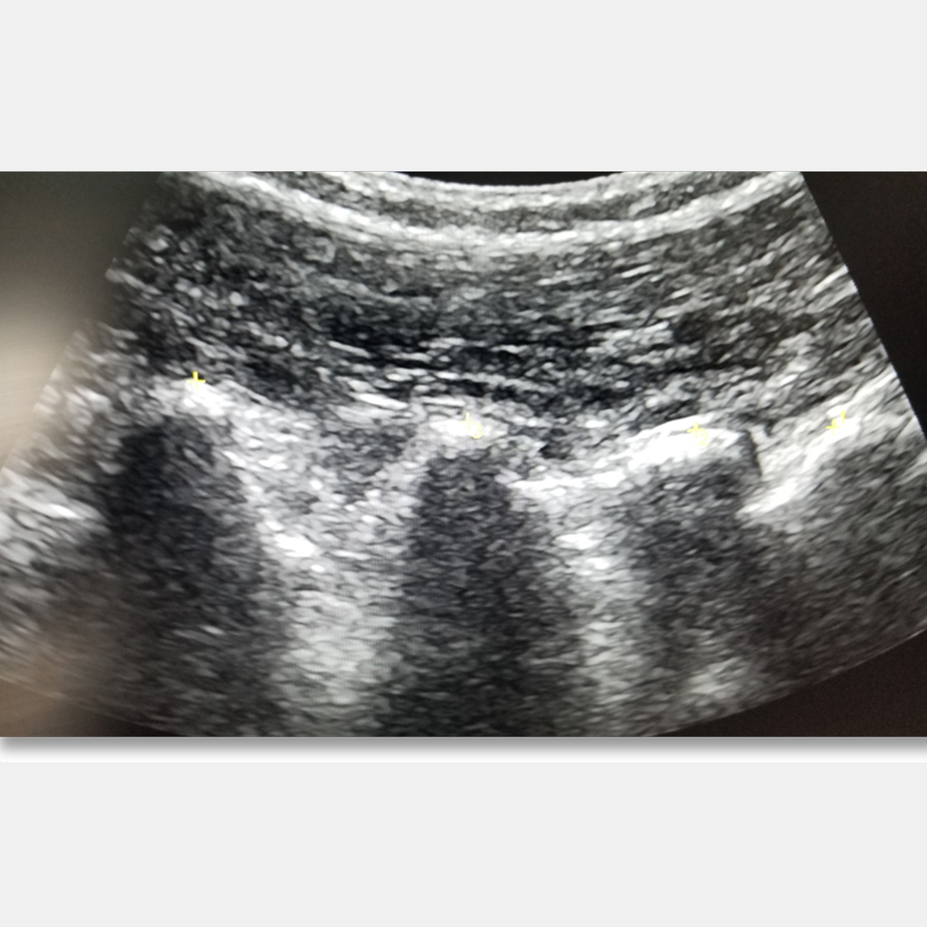 Inside Your Spine: What Happens During Carrolltown Flexion Distraction ...